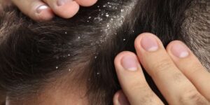 😣 ¿Sufres de caspa seborreica? Descubre cómo COMBATIRLA