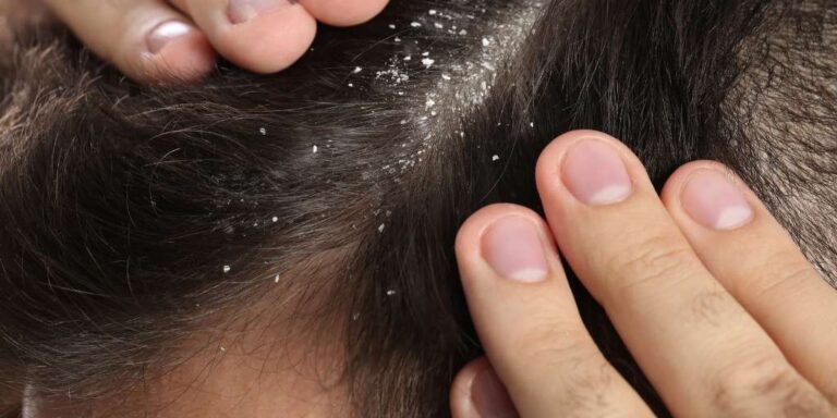 😣 ¿Sufres de caspa seborreica? Descubre cómo COMBATIRLA